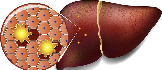 我国绝大部分肝硬化由慢性乙肝引发，千万别忽视！