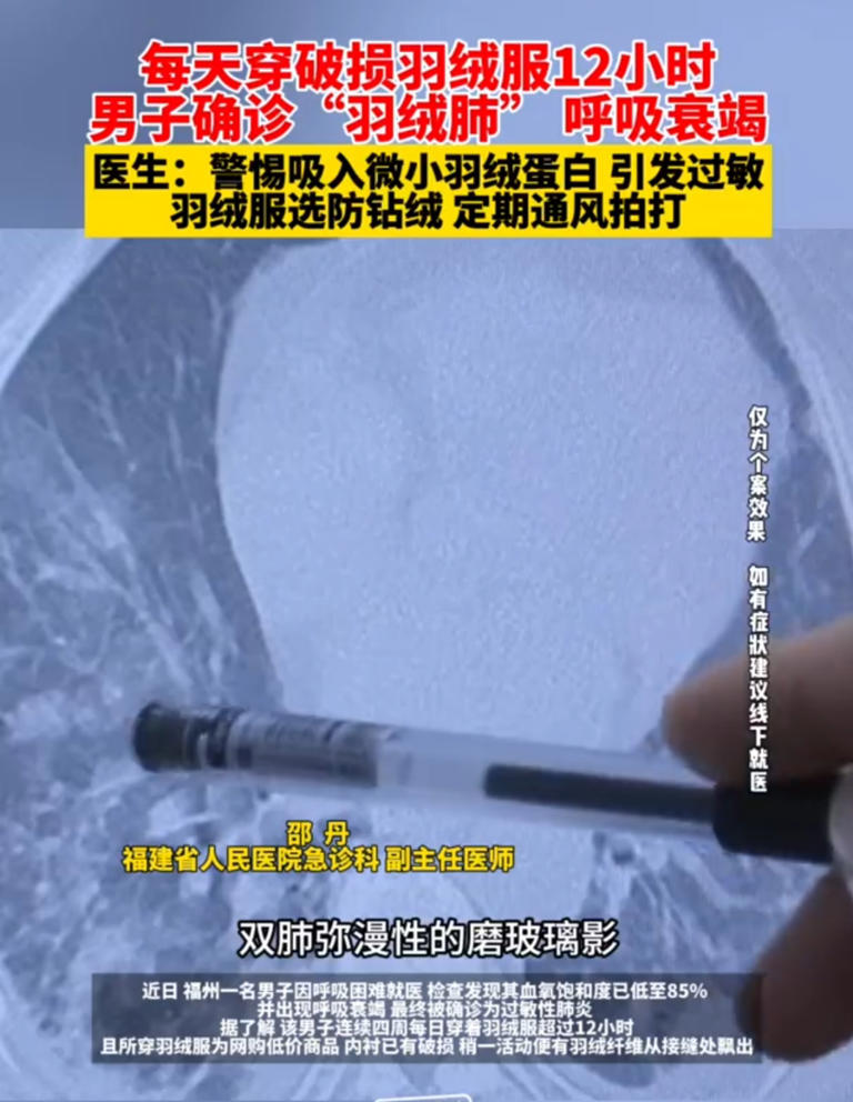 男子确诊“羽绒肺” 呼吸衰竭! 医生提醒